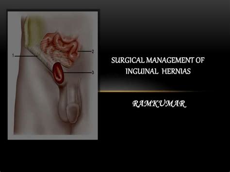 Obstructed And Stragulated Hernia1 Pptx Obstructed And Stragulated Hernia1 Pptx