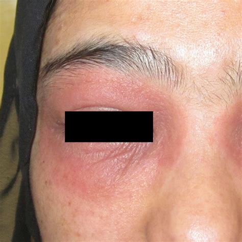 Allergic Contact Dermatitis Dermalive