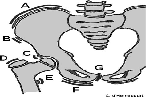Treatment Of Iliac Crest Apophysitis In The Young Athlete Wi Clinical Journal Of Sport Medicine