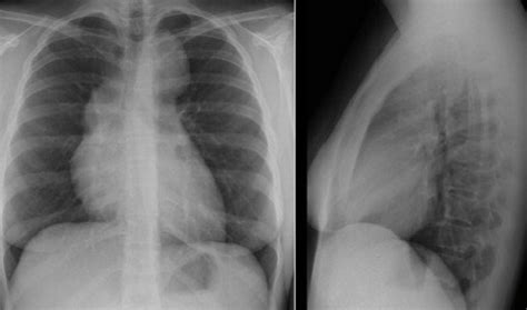 X Ray Cervical Spine Ap Lat Teleradwin