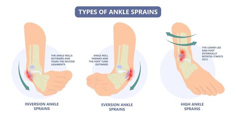 How To Recognize A High Ankle Sprain — Dr Elton