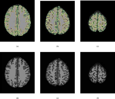 Figure 10 From Adaptive Reproducing Kernel Particle Method For Extraction Of The Cortical