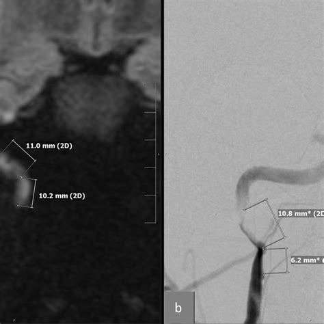 Case 27 Dwi Hyperintensity Compared With Dsa A Coronal Dwi Which Download Scientific Diagram