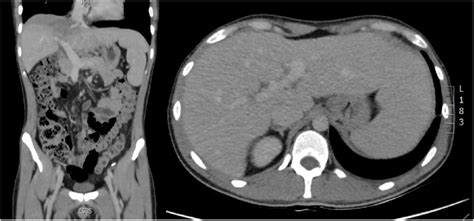 Control Ct Scan At One Month Revealing Normal Liver Tissue Without
