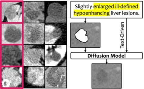 논문 리뷰 Text Driven Tumor Synthesis