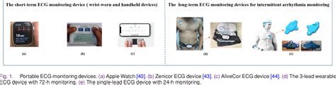 Figure 1 From A Review On Atrial Fibrillation Detection From Ambulatory Ecg Semantic Scholar