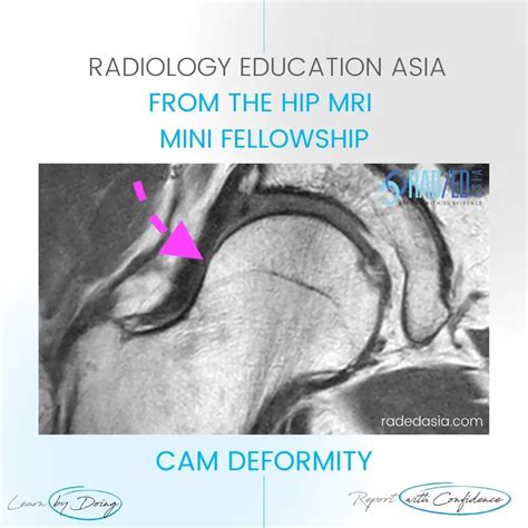Mri Hip Cam Fai Femoro Acetabular Impingement Radiology Education Asia