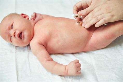 Omphalitis In Newborn Babies Causes Signs And Treatment Being The