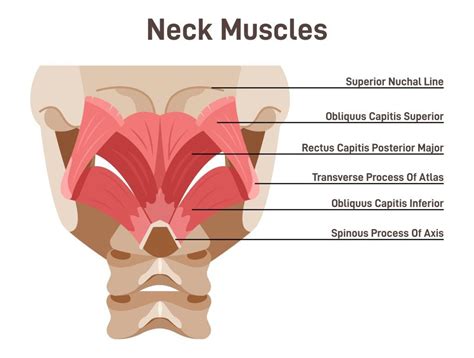 Suboccipital Muscle Trigger Points Causes Symptoms And Treatment Trigger Point Secrets