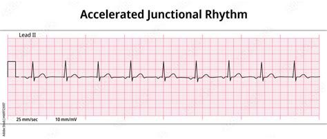 Ecg Accelerated Junctional Rhythm Escape Rhythm 8 Second Ecg Paper