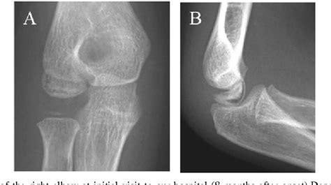 Figure 1 From Treatment And Diagnosis Of Panners Disease A Report Of
