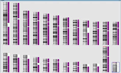 An Example Patient Number 1 In Table 1 Of Complete Hydatidiform Mole