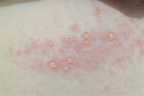 How To Manage Common Autoimmune Skin Conditions