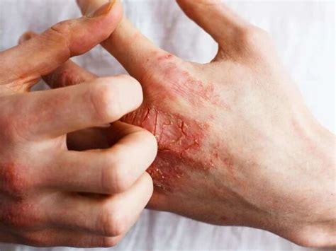 10 عامل ایجاد حساسیت پوستی داروخانه آنلاین ویتامین ث