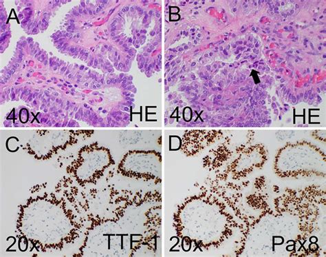 Histology Of Choroid Plexus Metastasis Microscopic Examination Shows Download Scientific