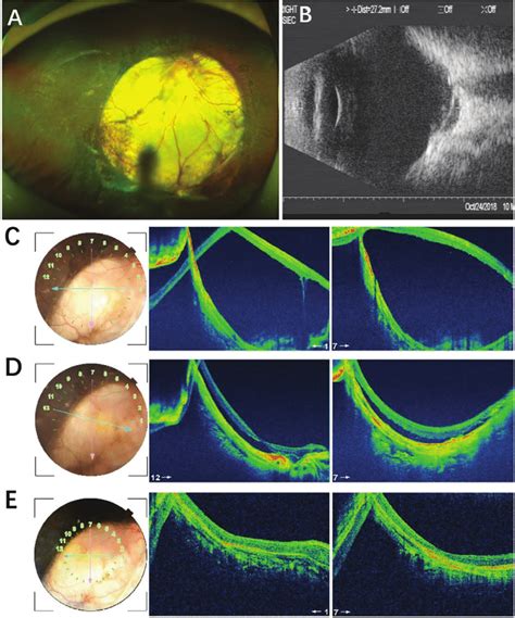 Ocular Examination Of The Right Eye A Scanning Laser Ophthalmoscopy Download Scientific