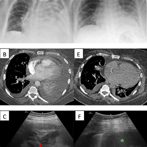 Chest X Ray Chest Computed Tomography And Thoracic Ultrasound Images