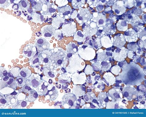 Histiocytes In Peritoneal Fluid