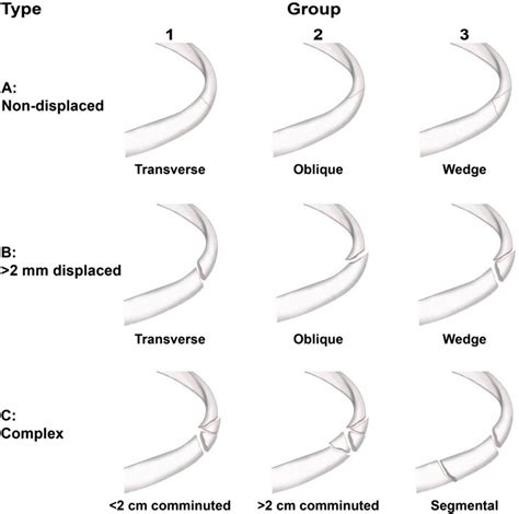 Classification Of Rib Fractures Download Scientific Diagram