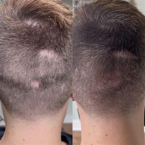 Scalp Pigmentation Cosmetic Ink Studios