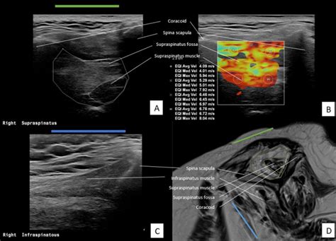 超声和剪切波弹性成像评估肩袖质量的有效性european Radiology X Mol