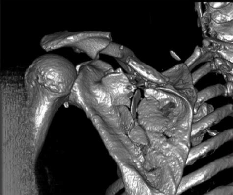 3d Reconstruction Ct Scan Of Left Scapula Showing Segmental Fracture Of Download Scientific