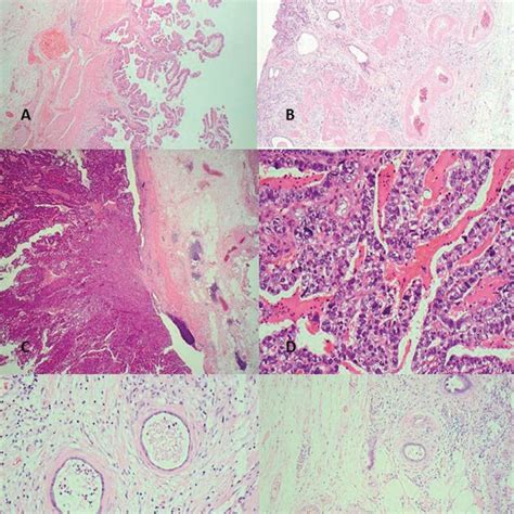 Histological Appearances Of Gallbladder Carcinoma A Incidentally