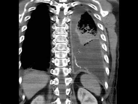 Thorax 8 2 Pleural Space Case 8 2 1 Effusion And Empyema Ultrasound Cases