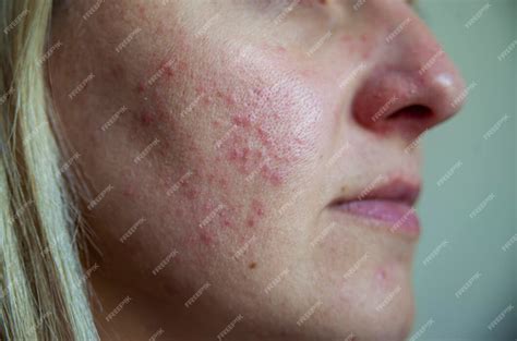 피부 문제 를 가진 어린 소녀 사진 여드름 및 Demodecosis 치료 전 및 후 피부 치료 스파 치료 화장품 및 전문 피부 관리 프리미엄 사진