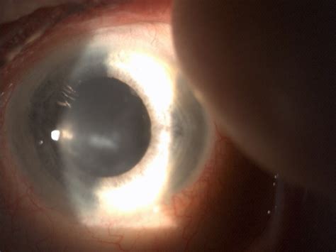 Corneal Scar Gallery Gulani Vision Institute