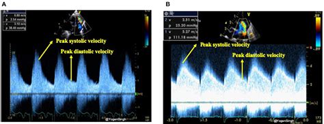 Frontiers Echocardiographic Diagnosis And Hemodynamic Evaluation Of Patent Ductus Arteriosus