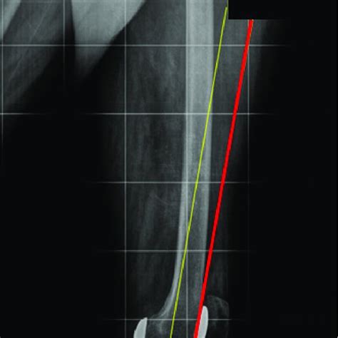 The Measurement Method Of Sagittal Femoral Bowing α Angle And Download Scientific Diagram