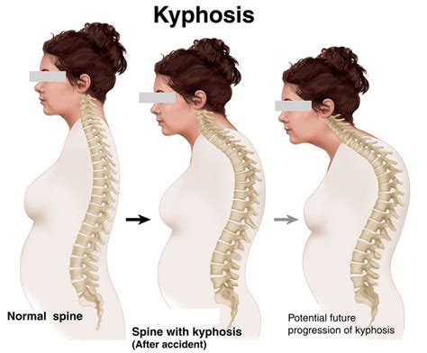 Kyphosis Anatomy And Physiology Pinterest The Ojays And Pennies