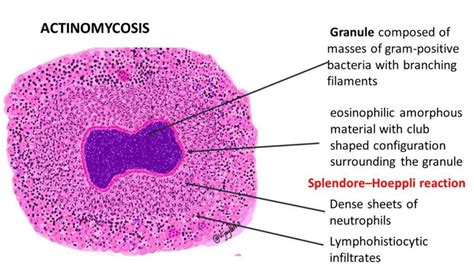 Actinomycosis Focus Dentistry