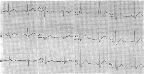 13 10 完全性右束支阻滞 心电图诊断解读 医学