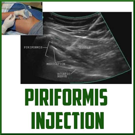 Performing A Piriformis Muscle Injection My Blog