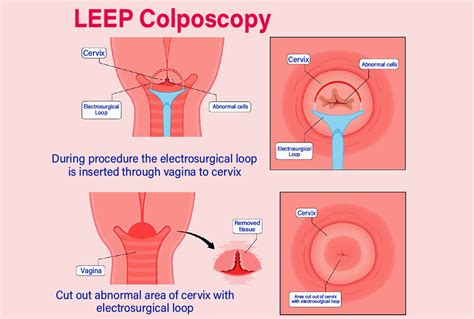 Colposcopy And Cervical Biopsy In Turkey Cevre Hospital