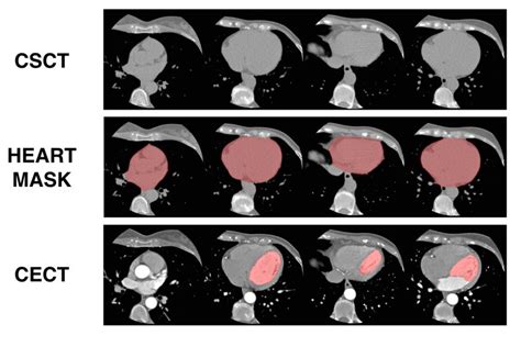 Heart Segmentation Examples In The Upper Row Axial Projections Coming Download Scientific