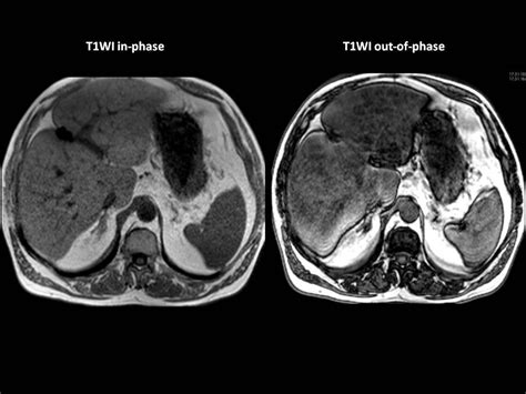 Ascending Cholangitis Pacs