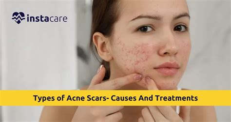 Understand The Types Of Acne Scars Causes And Treatments