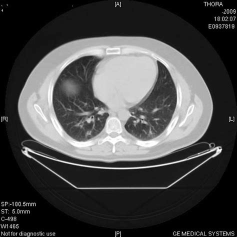 Ct Scans Showing The Good Response Of Pulmonary Lesions After Eight Download Scientific Diagram
