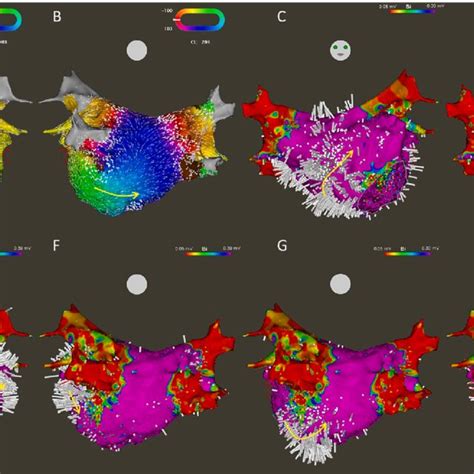 A Representative Case Of Macroreentrant At With Diagnostic Agreement
