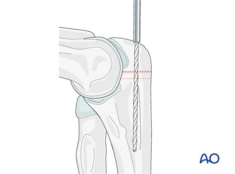Transolecranon Approach To The Distal Humerus
