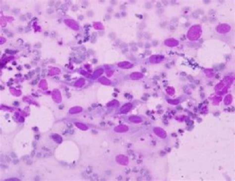 Figure 1 From Polypoid Cystitis Masquerading As Leiomyoma Of Urinary