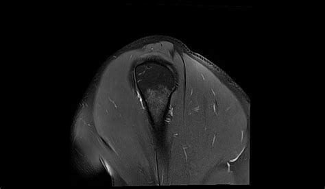 Plan Shoulder Sag T2 Mrimaster