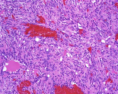 Histopathology Of Spindle Cell Vascular Tumors Surgical Pathology Clinics