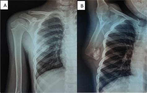 A And B X Rays Shoulder Ap And Scapular Y View Showing Pedunculated Download Scientific Diagram