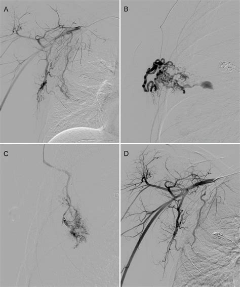 Transarterial Embolotherapy Of The Right Posterior Chest Wall Download Scientific Diagram