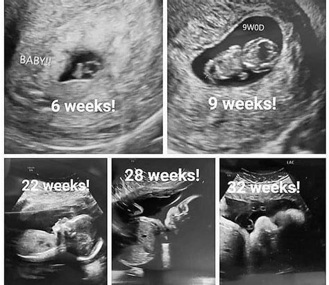 Pregnancy Ultrasounds Pregnancy Ultrasound At Crystal Radiology