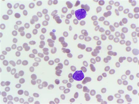 Hypergranular Apml Only Cells